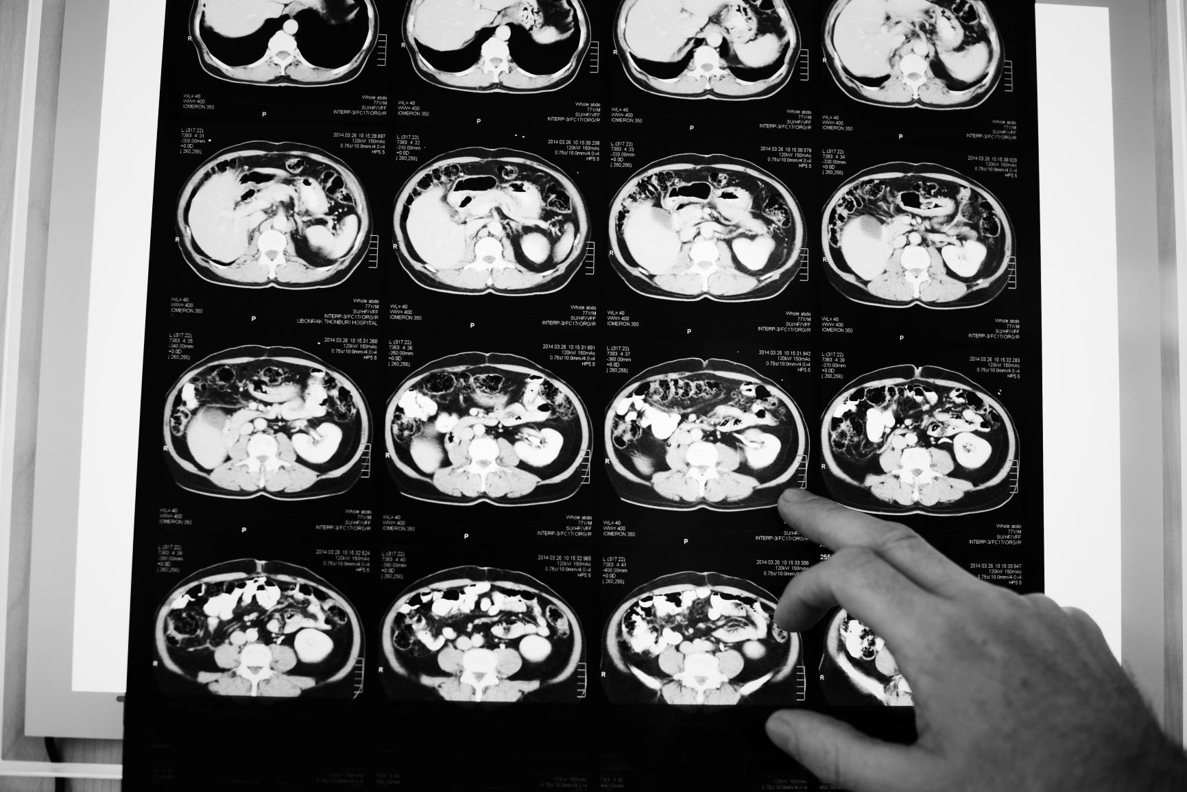 Ep 63 Deep Brain Stimulation With Guest Dr Laura Cabrera Elizabeth Ep 63 Deep Brain Stimulation With Guest Dr Laura Cabrera Elizabeth